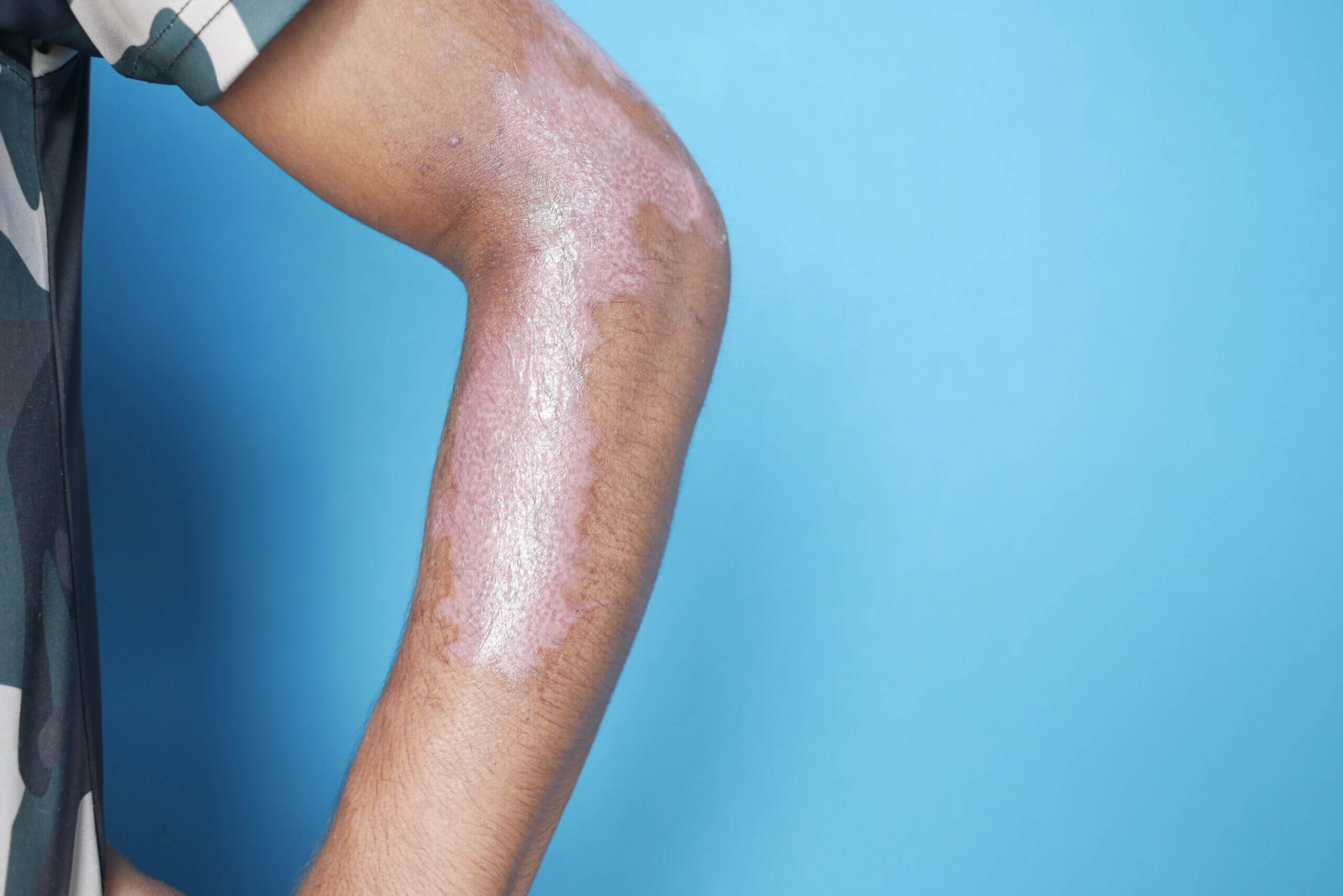 Booneville Burn Injury Lawyer | Langston & Lott, PLLC